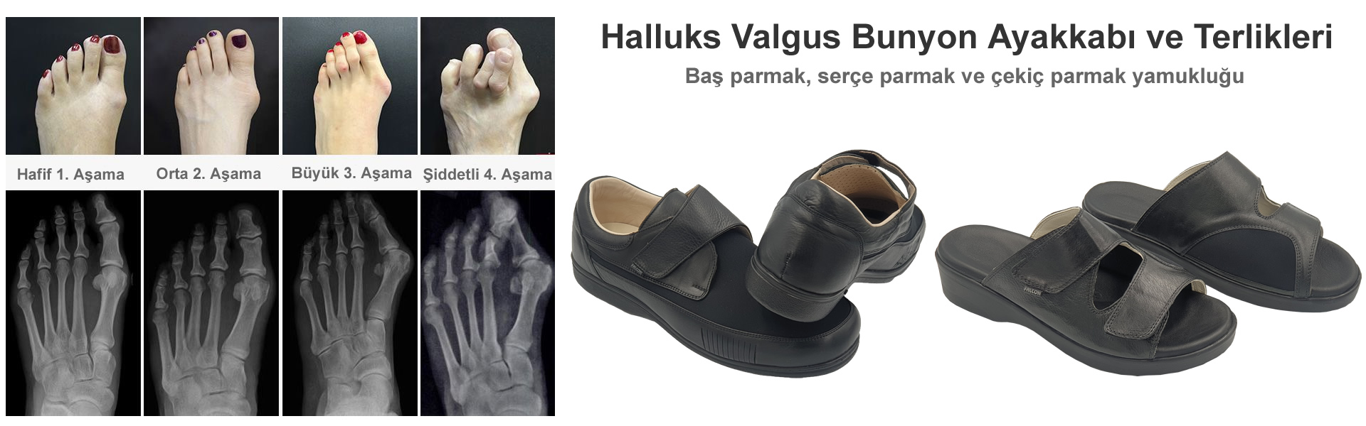 Ortopedik Terlik & Ayakkabı: Topuk Dikeni, Diyabet, Halluks Valgus